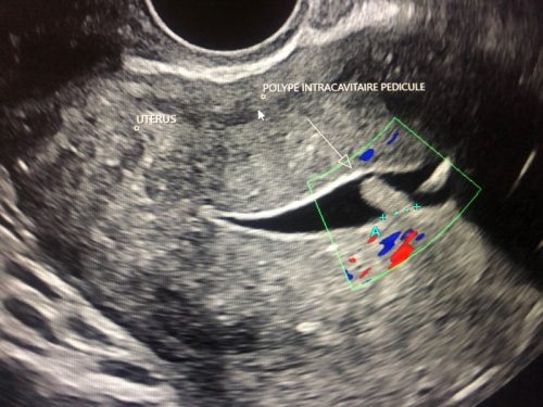 Hystérosonographie - Imapôle Lyon-Villeurbanne