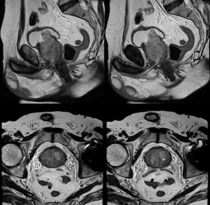 Multi Paramétrique de la Prostate - Imapôle Lyon-Villeurbanne